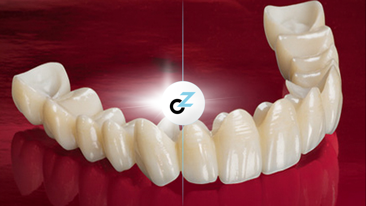 Qual o melhor tipo de prótese fixa? - OdontoZ